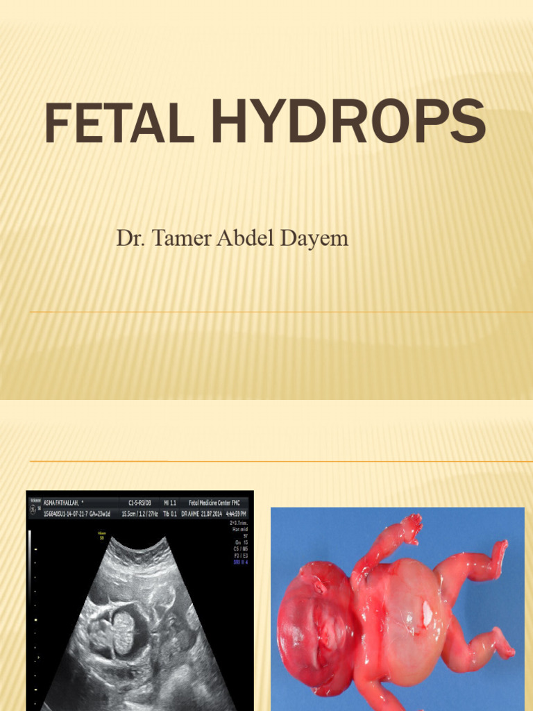 Fetal Hydrops | PDF | Clinical Medicine | Diseases And Disorders