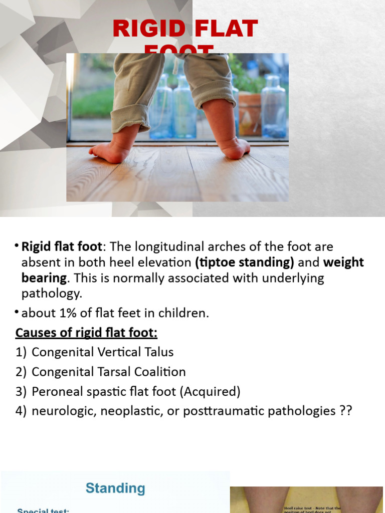 Rigid Flat Foot | PDF | Foot | Musculoskeletal Disorders
