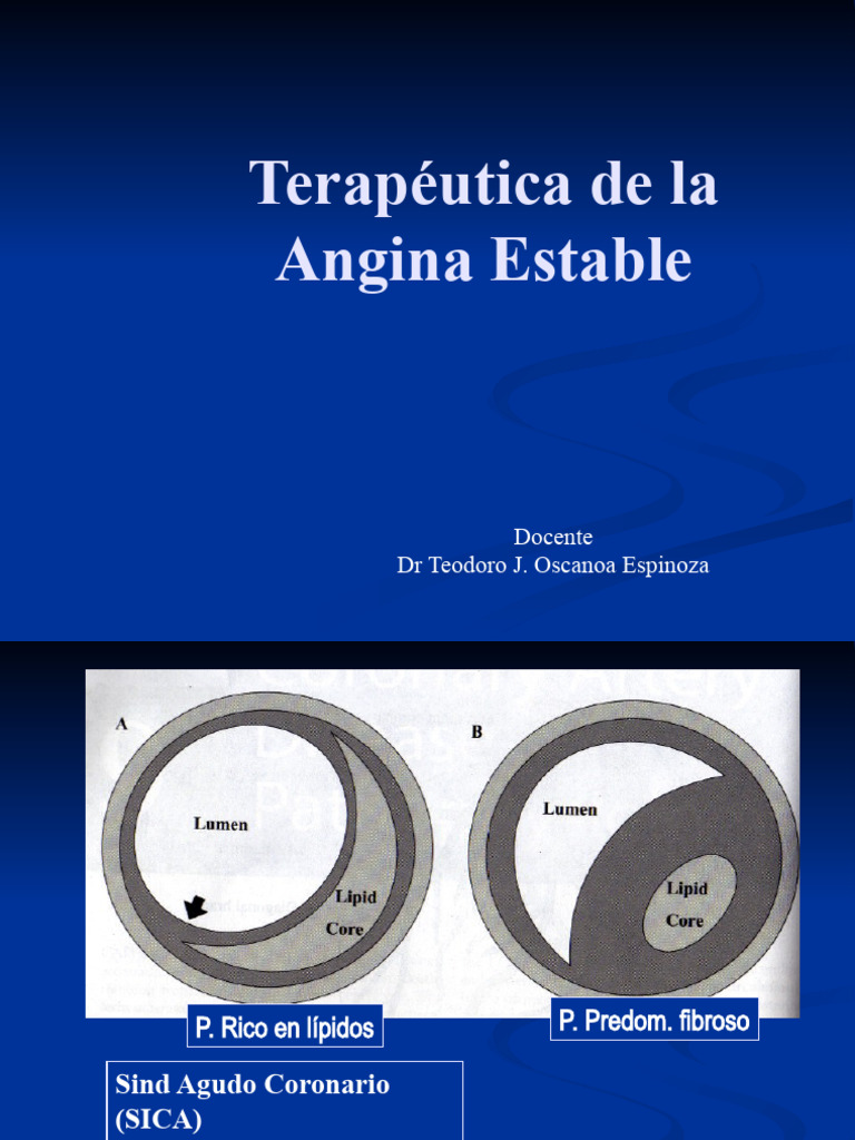 Usmp Angina Estable | PDF | Stent | Cardiología