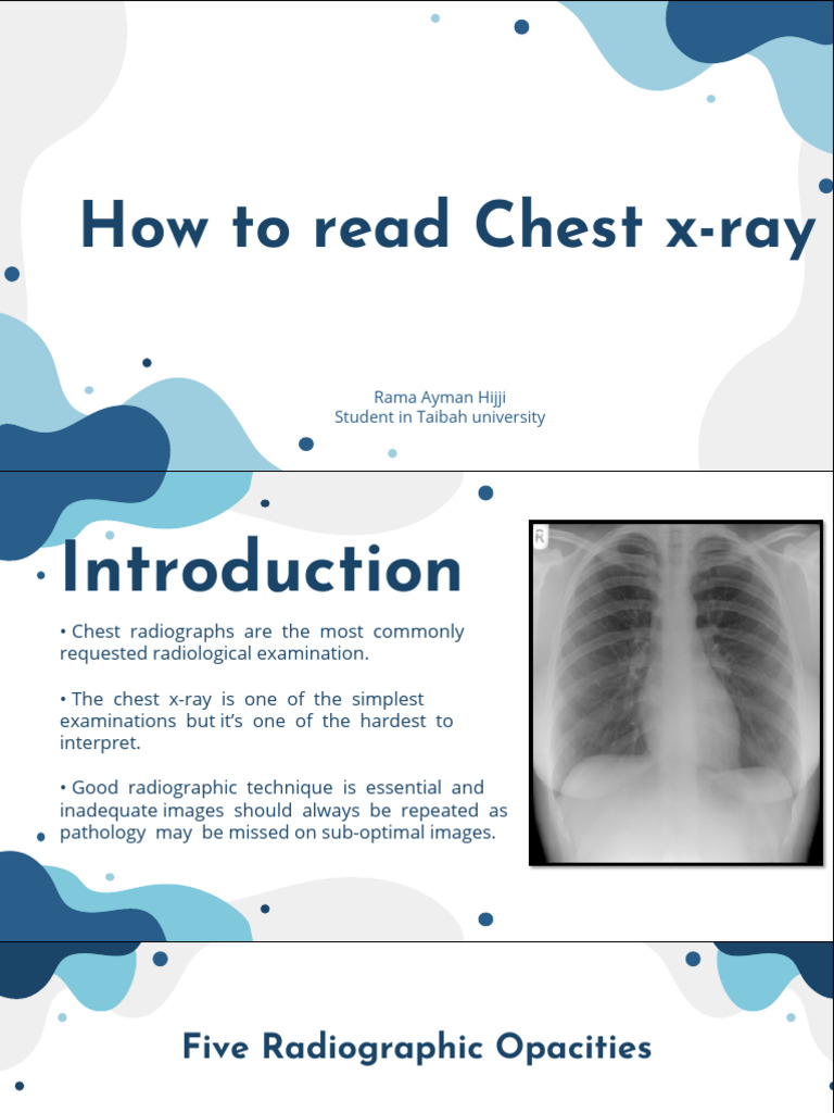 How To Read Chest X-Ray? | PDF