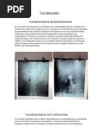 Colangiografía por Sonda T: Guía Completa | PDF | Bilis | Hígado