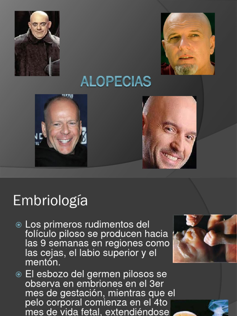 Alopecia, Vitiligo, Liquen Rojo Plano | PDF | Perdida de cabello ...