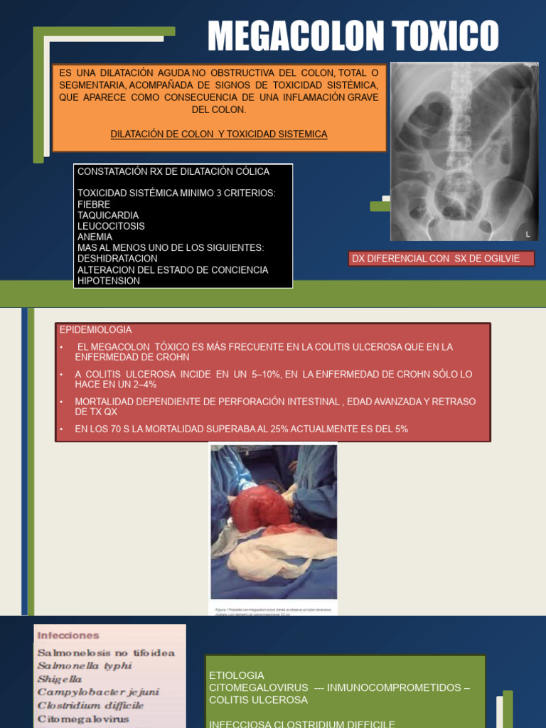 Megacolon Toxico | PDF | Colitis ulcerosa | Diarrea