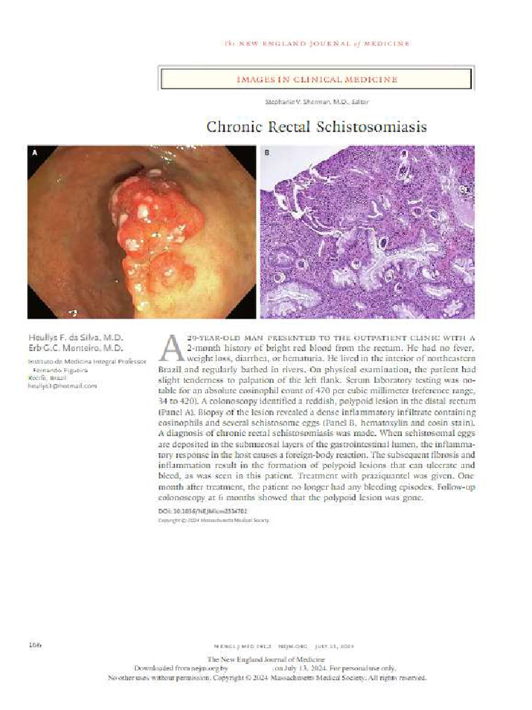 Schistosomiasis | PDF