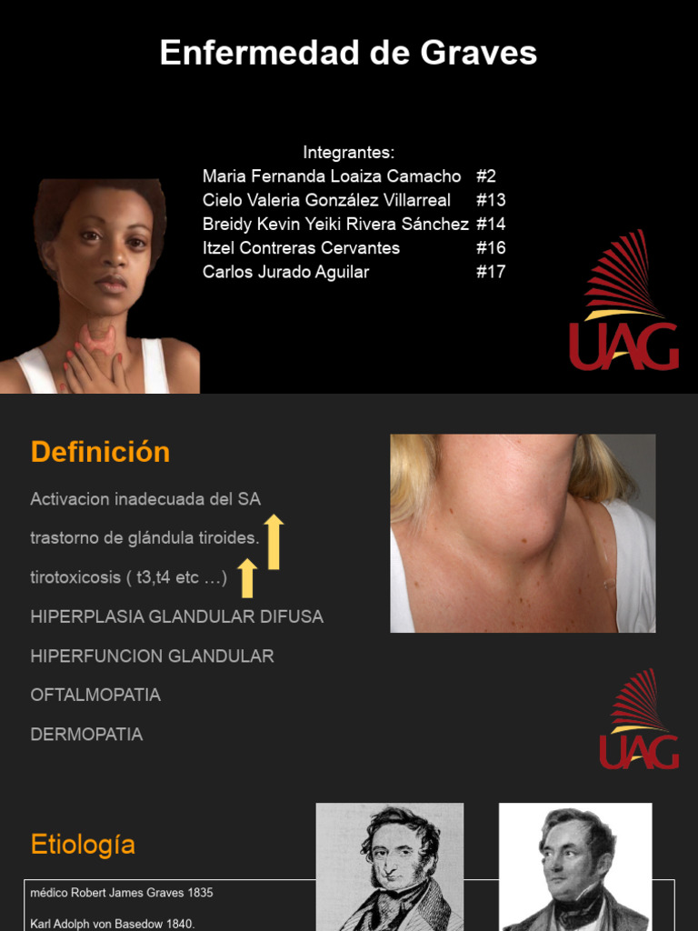 Enfermedad de Graves: Diagnóstico y Tratamiento | PDF | Tiroides ...