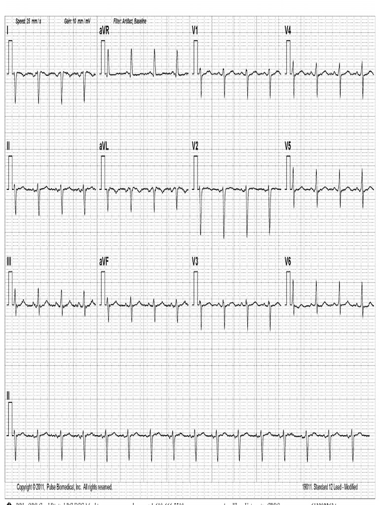 ECG | PDF