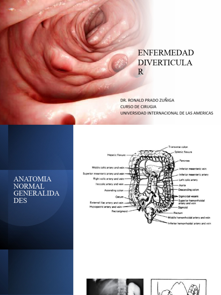DIVERTICULITIS | PDF | Enfermedades y trastornos | Especialidades Medicas