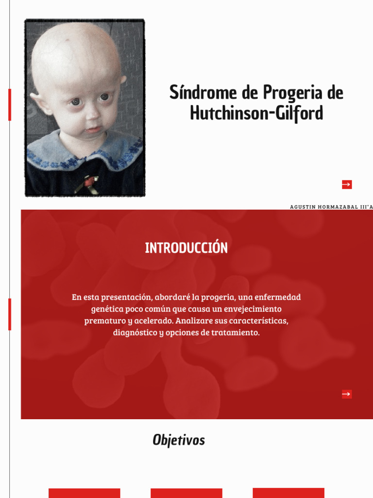 Progeria: Síntomas y Tratamientos | PDF | Enfermedades y trastornos ...