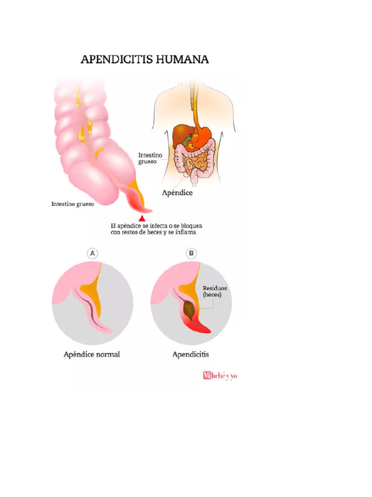 Apendicectomia | PDF