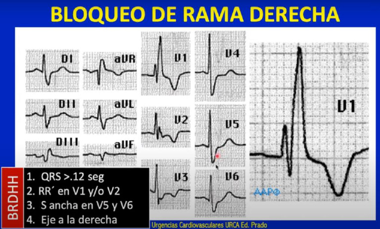 Bloqueo de Rama Derecha | PDF