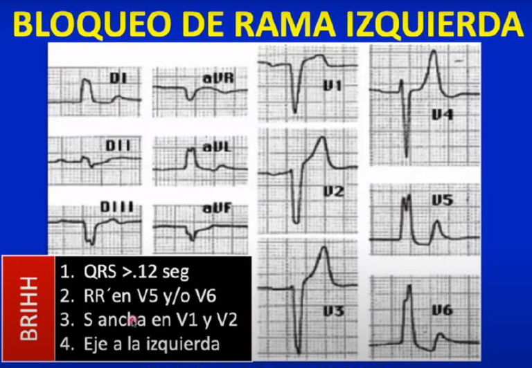 Bloqueo de Rama Izquierda | PDF
