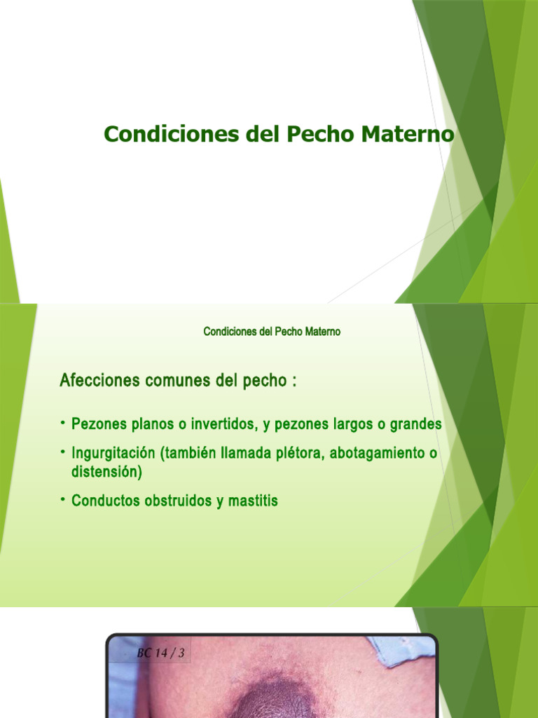 Afecciones Comunes del Pecho Materno | PDF | Pecho | Lactancia
