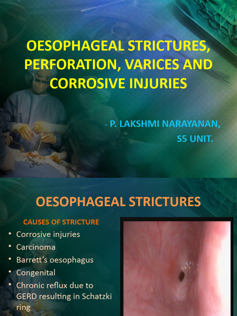 Oesophageal Stricture | PDF | Esophagus | Endoscopy