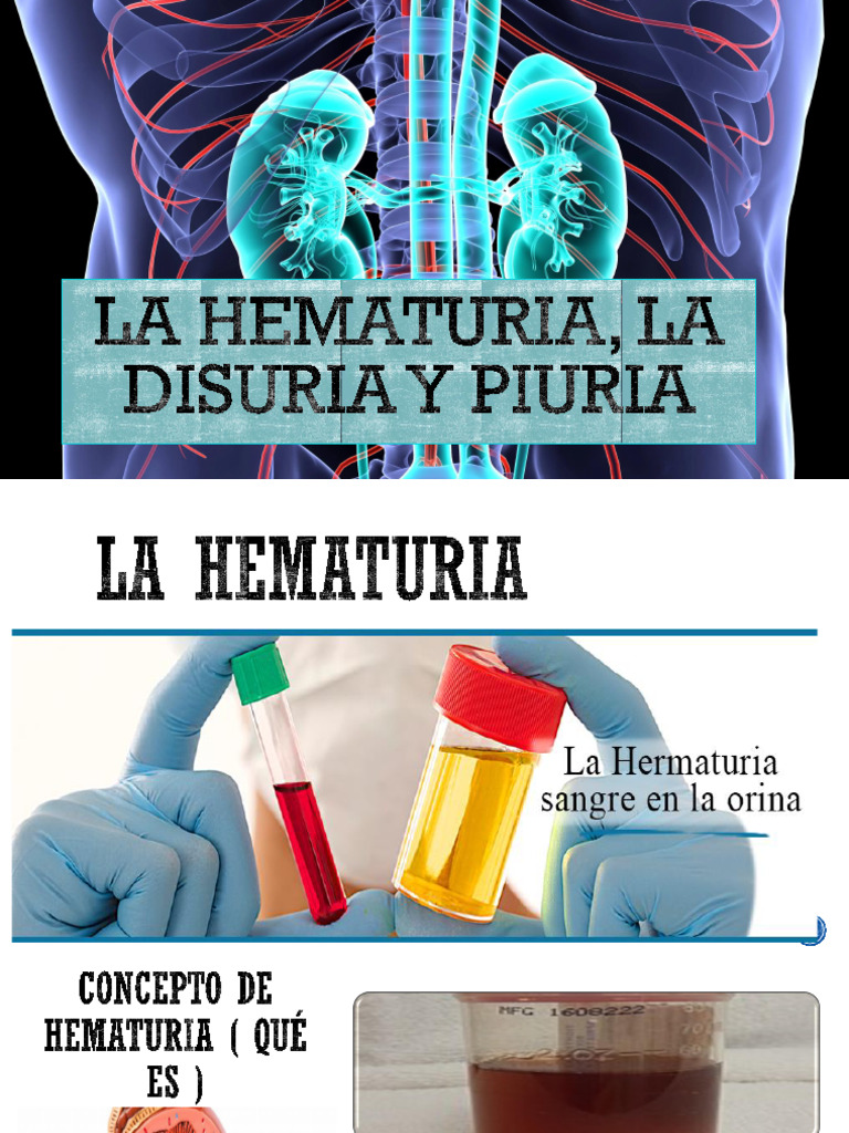 Hematuria, Disuria y Piuria: Causas y Tratamientos | PDF | Causas de la ...