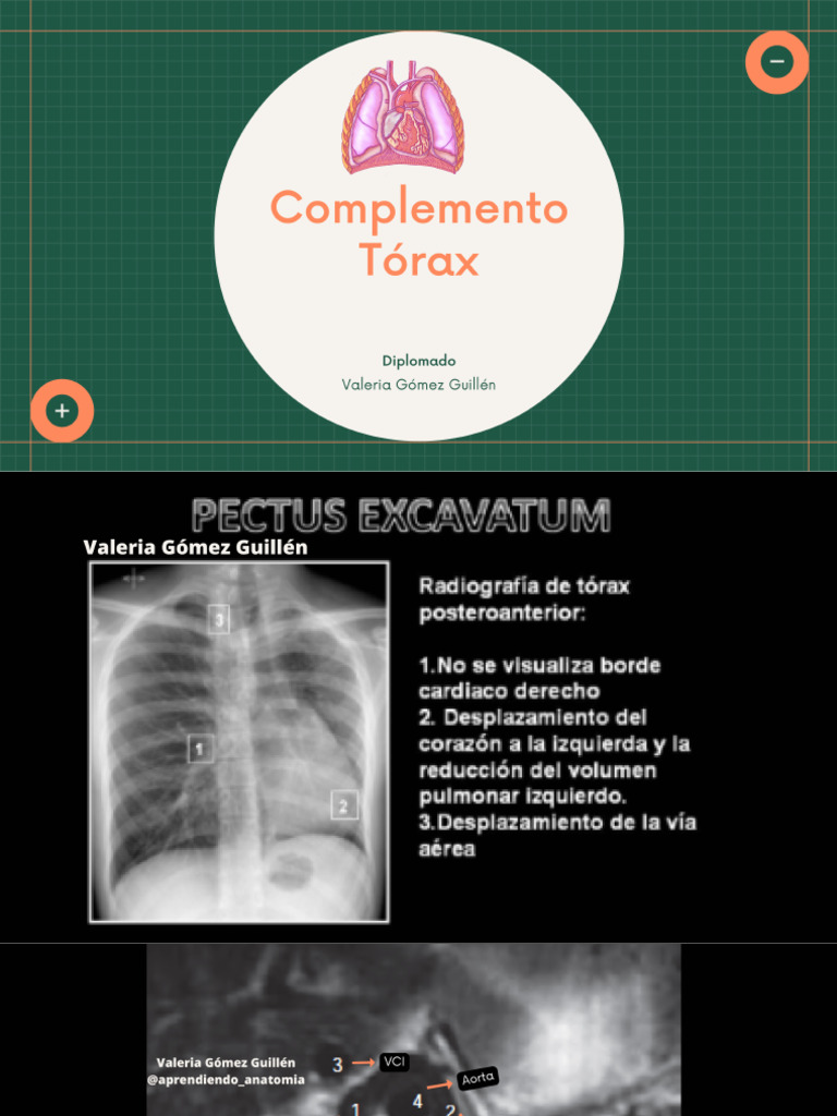 Complemento Tórax | PDF