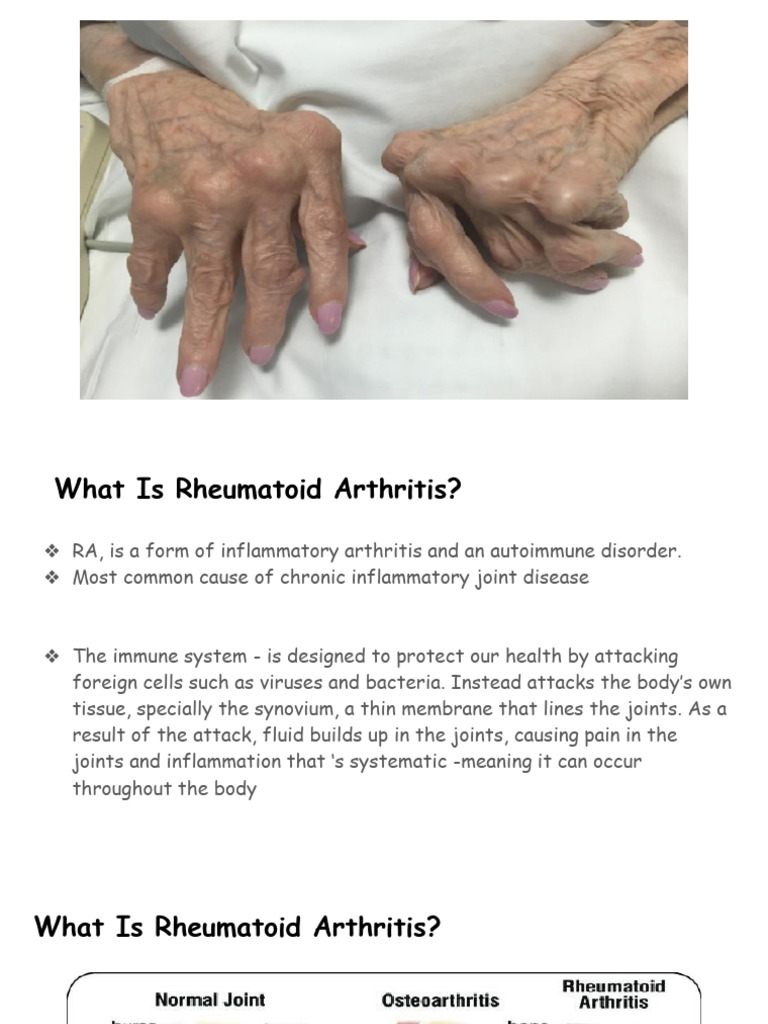 Rheumatoid arthritis | PDF | Rheumatoid Arthritis | Arthritis