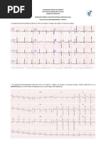 Infradesnivel y Supra del ST en ECG | PDF