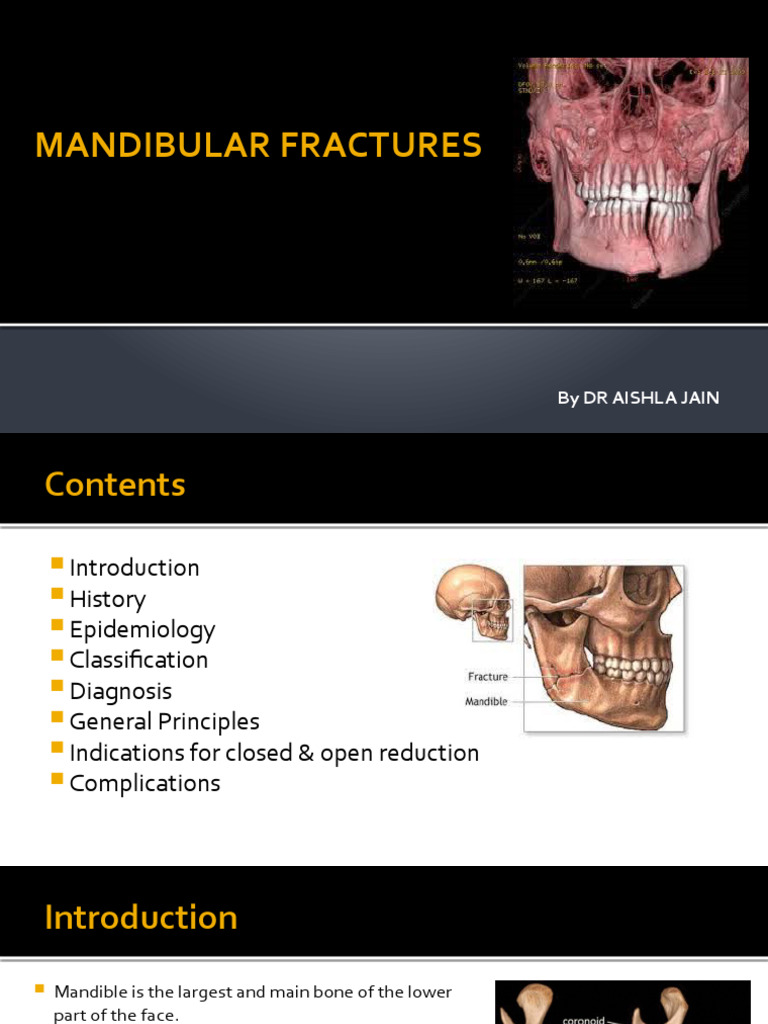 Mandibular Fractures Overview and Treatment | PDF | Medical Specialties ...