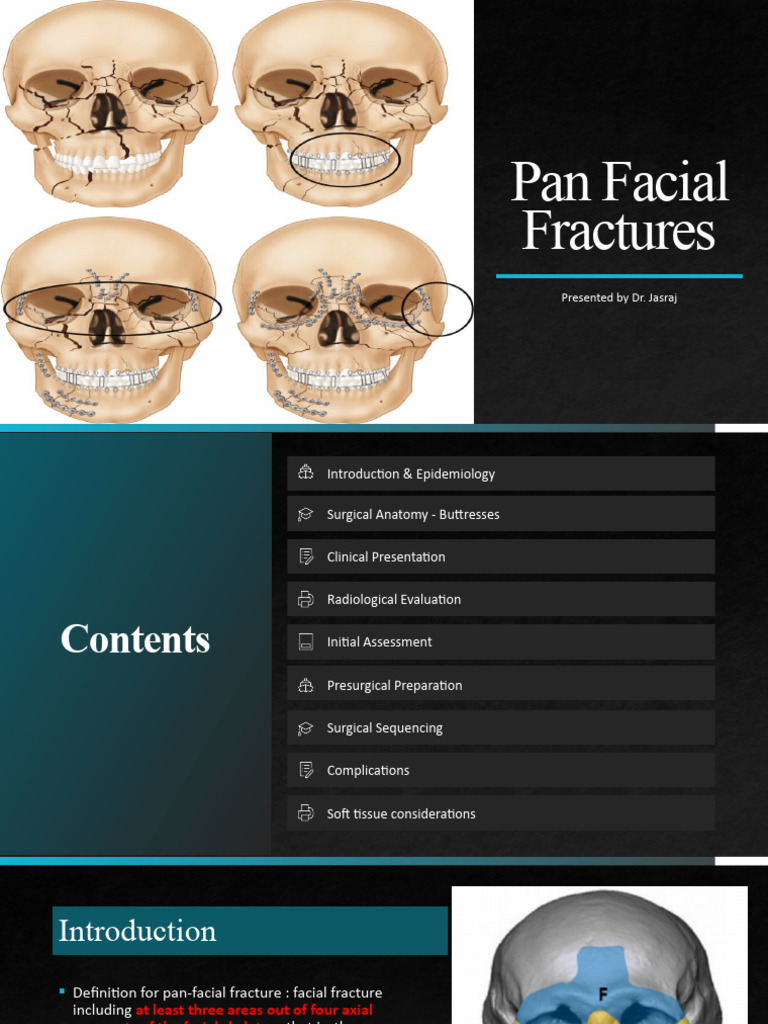 JD Panfacial Fractures 2 | PDF | Skull | Human Anatomy