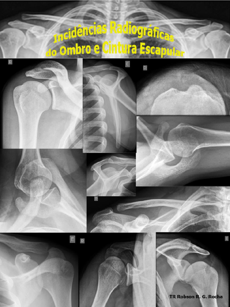 Radiografias Do Ombro - Livro Slide - Prof. Robson R G Rocha | PDF ...