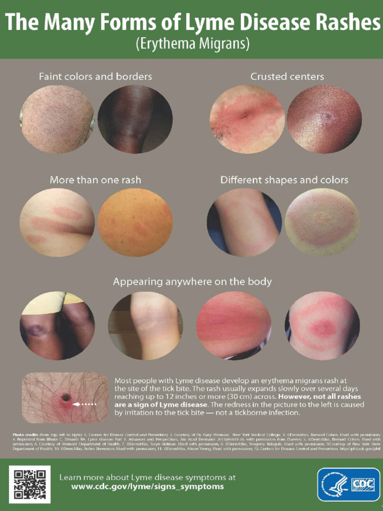 The Many Forms of Lyme Disease Rashes CDC | PDF