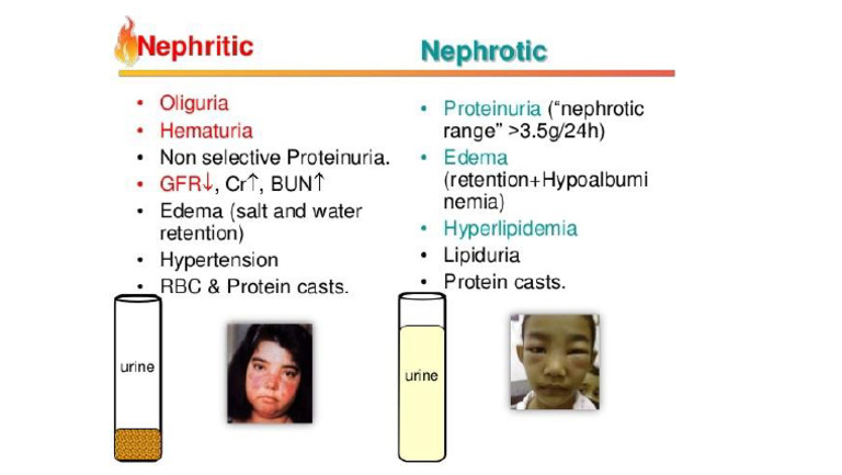 9.som Sindrom Nefrotik VS Nefritik | PDF