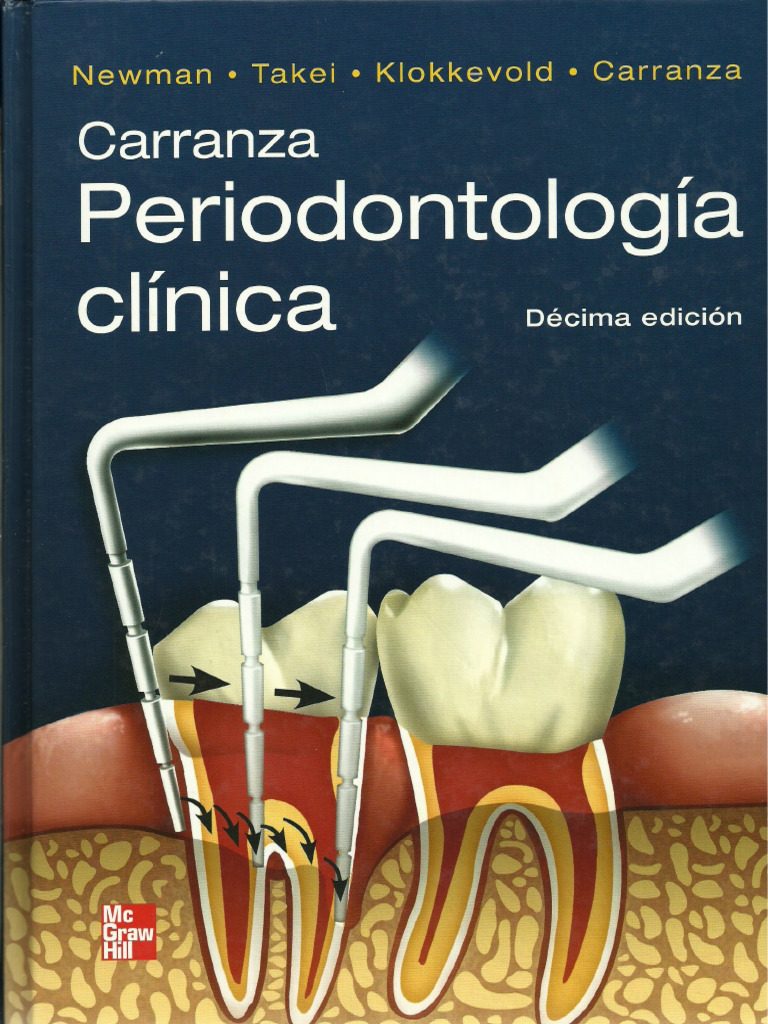 Instrumentación Periodontal. Capítulo Carranza | PDF