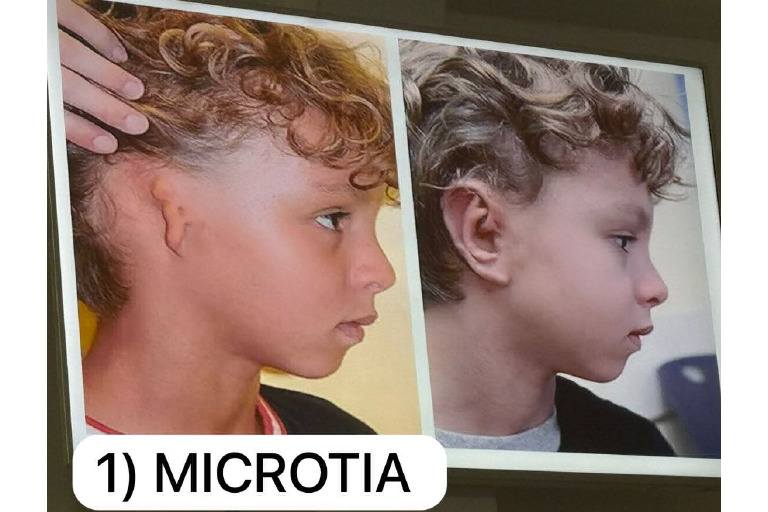 MICROTIA | PDF
