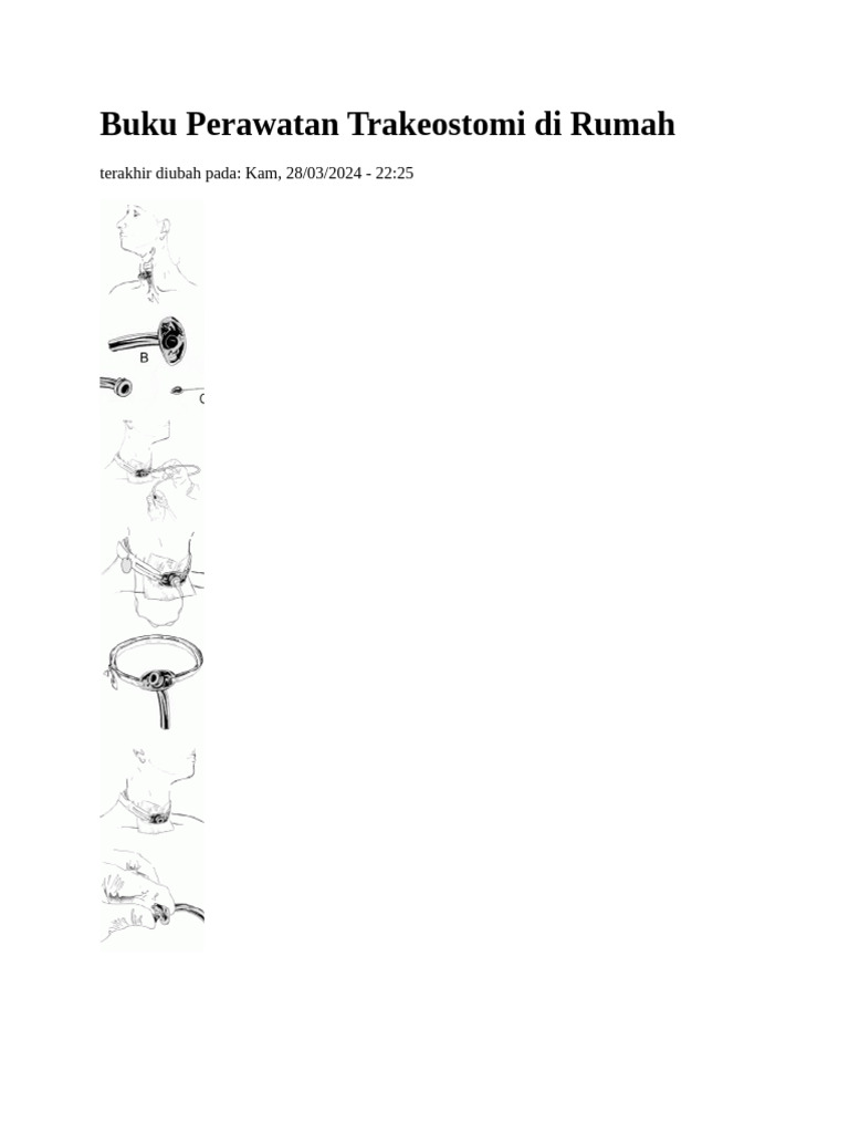 Trakeostomi | PDF