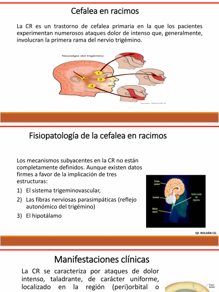 Cefalea en Racimos | PDF