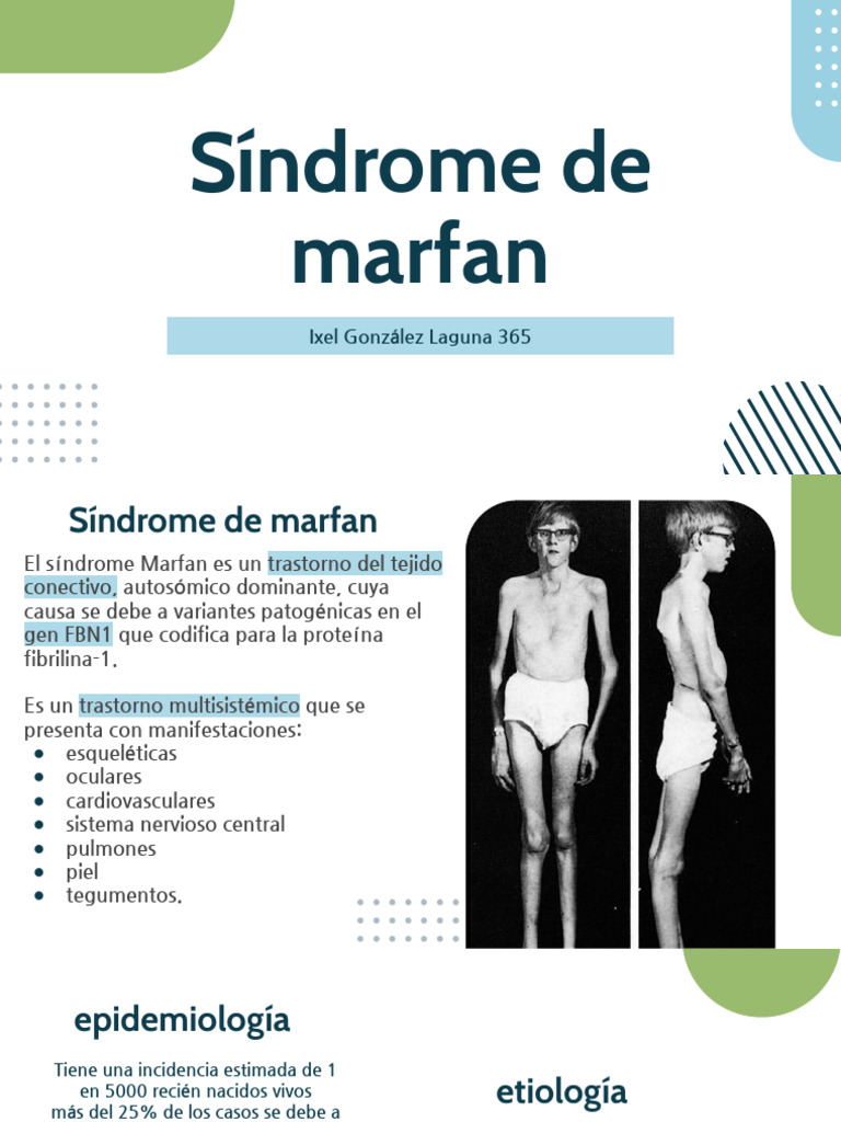 Síndrome de marfan | PDF