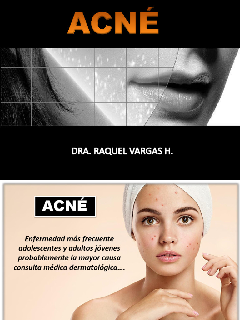 ACNE(2) | PDF