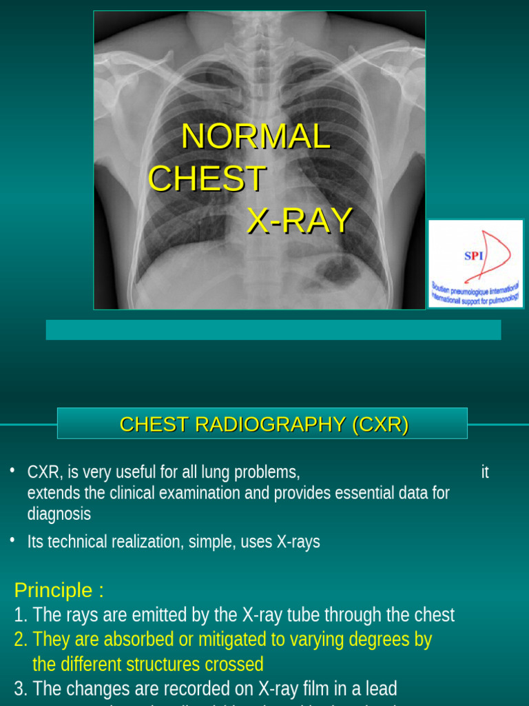 Normal CXR | PDF