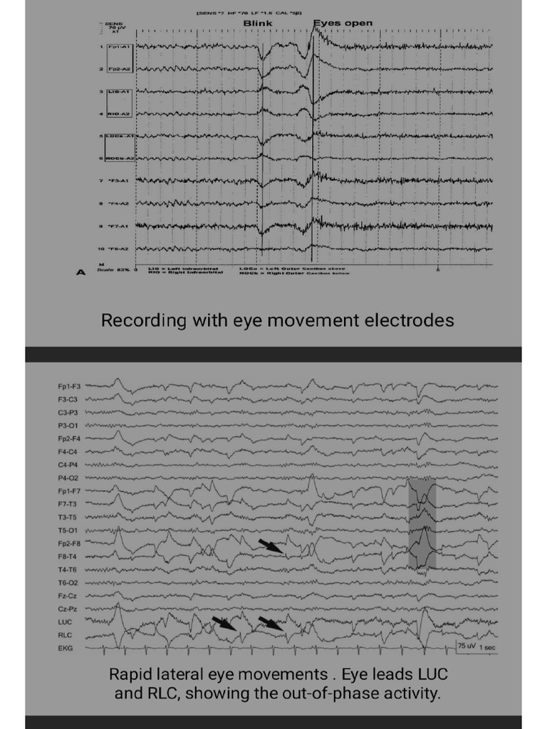 Artifacts Related To EEG | PDF