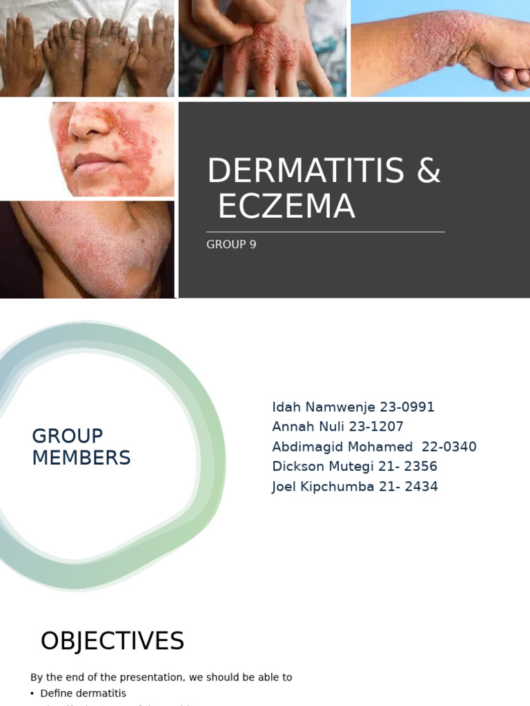 Dermatitis and Eczema | PDF | Dermatitis | Topical Medication