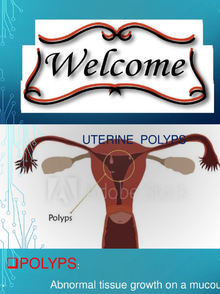 Uterine Polyp | PDF