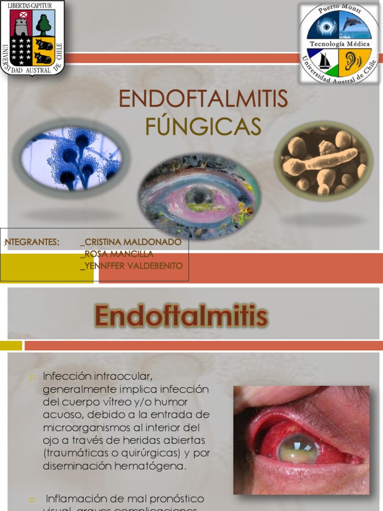 Endoftalmitis Fungica Final | PDF | Ojo humano | Hongo