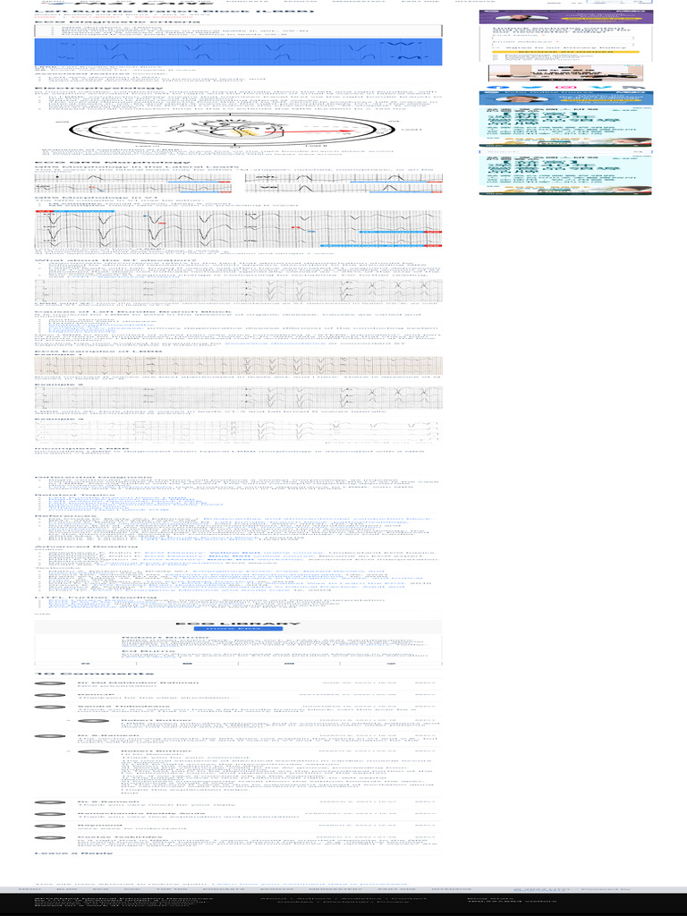 Left Bundle Branch Block (LBBB) - LITFL - ECG Library Diagnosis | PDF ...