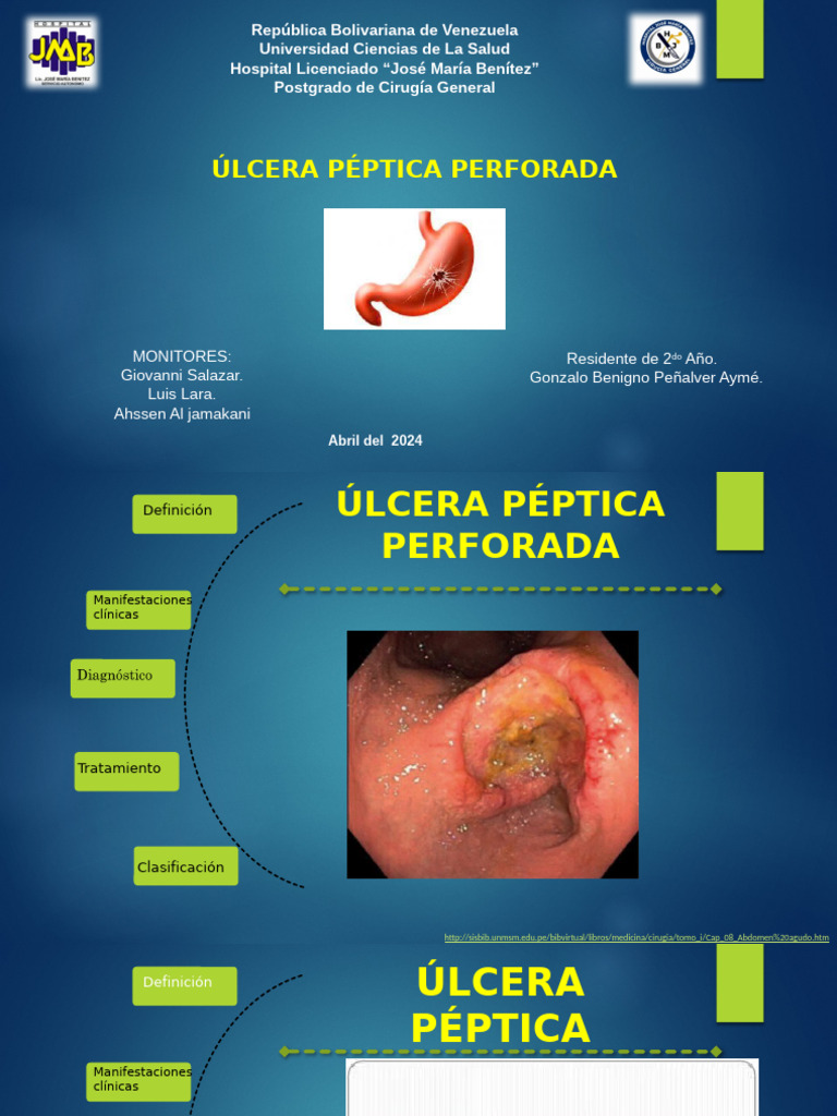 Ulcera Peptica Perforada | PDF