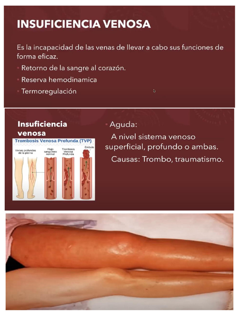 Parte1 - Insuficiencia Venosa | PDF