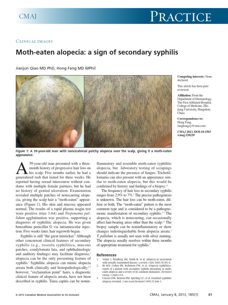 Sifilis Alopesia | PDF