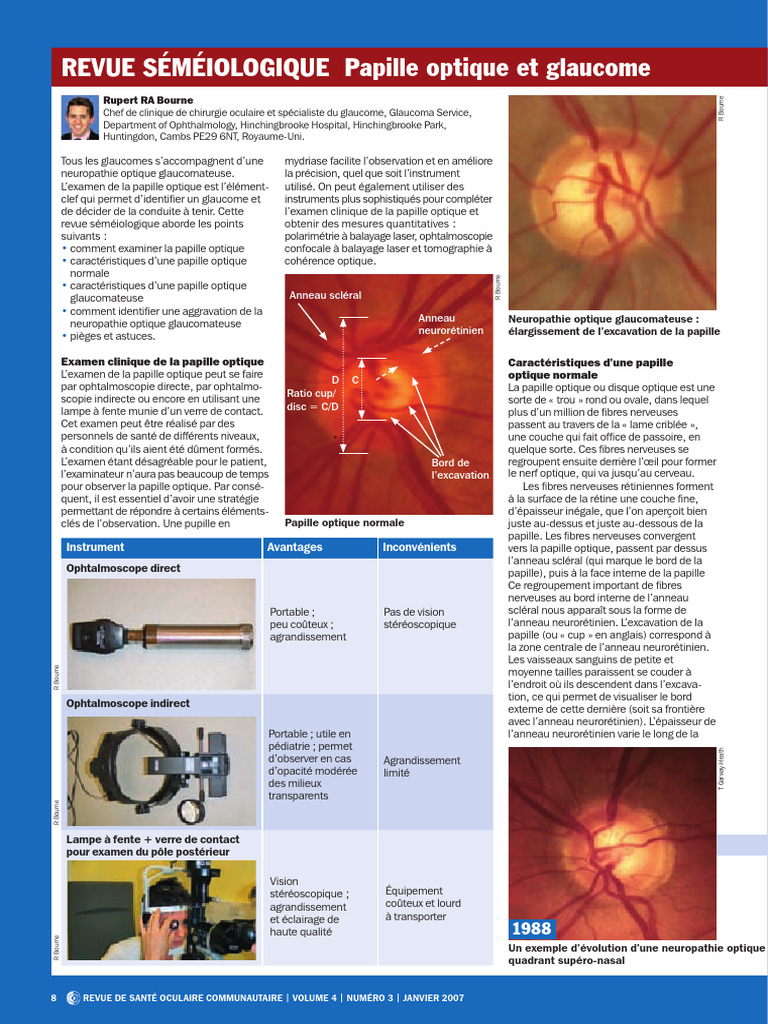 Papille Optique Et Glaucome | PDF