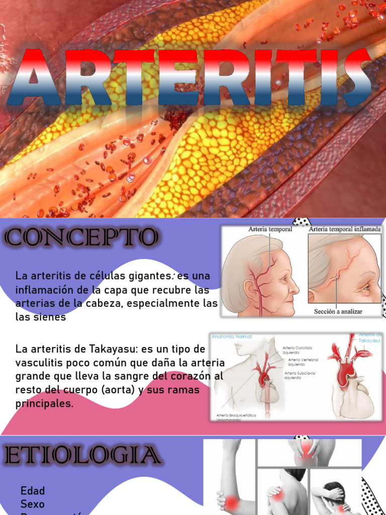 Arteritis | PDF