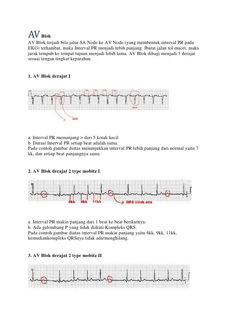 AV Blok | PDF