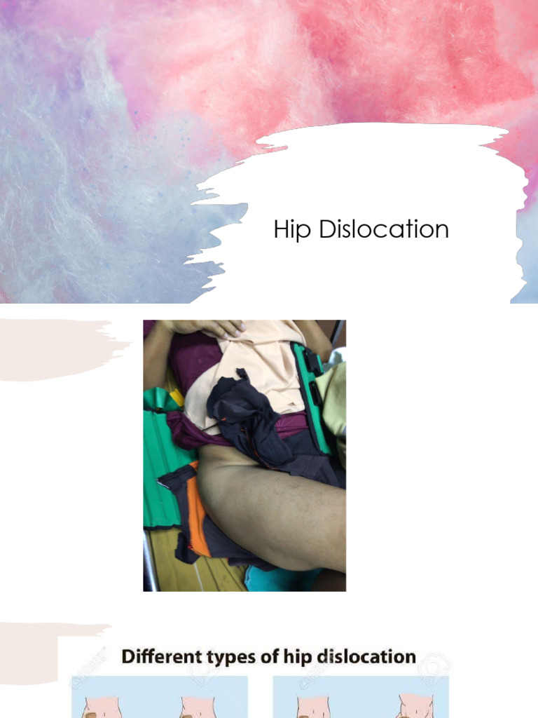Hip Dislocation | PDF