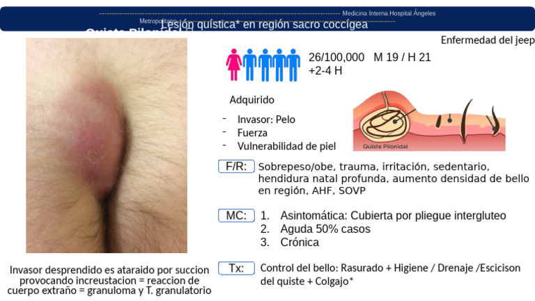 Quiste Pilonidal Resumen | PDF