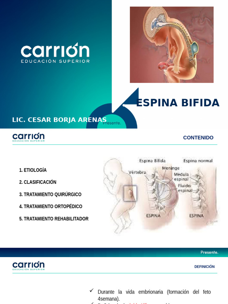 13 Espina Bifida | PDF