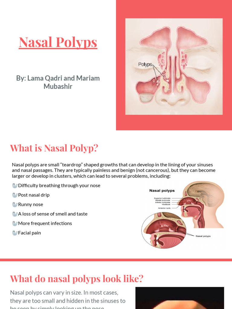 Nasal Polyp | PDF