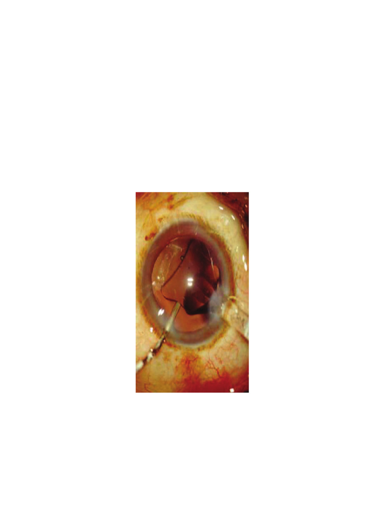 Mastering Intraocular Lenses IOLs | PDF