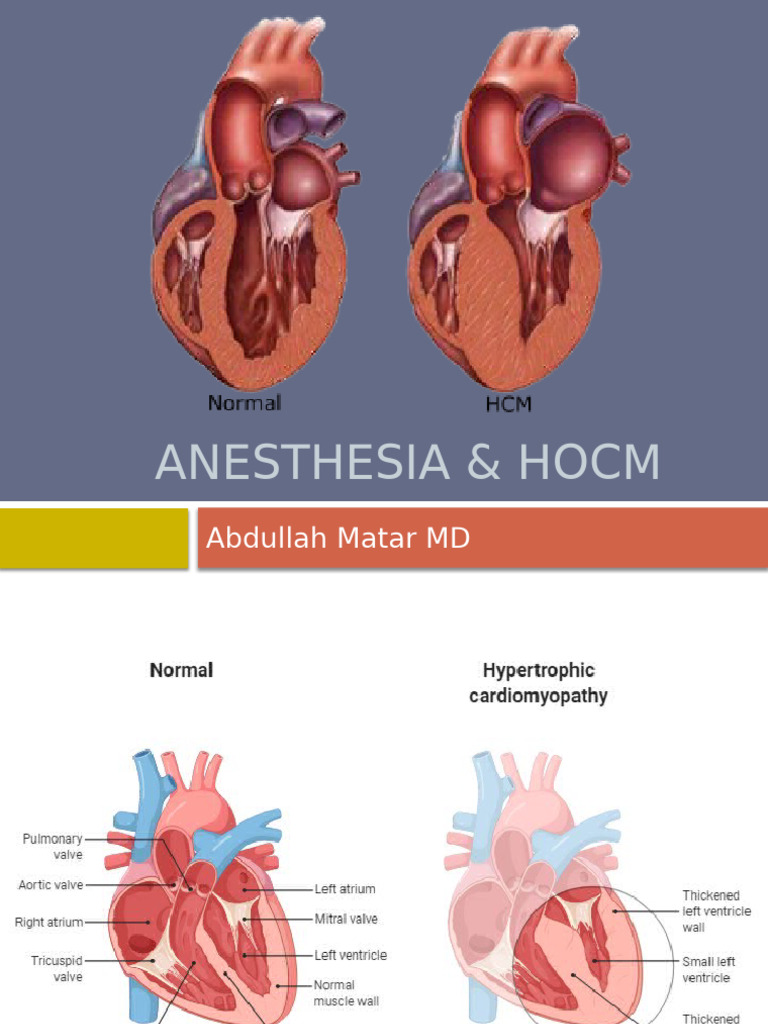 Anesthesia & HOCM | PDF